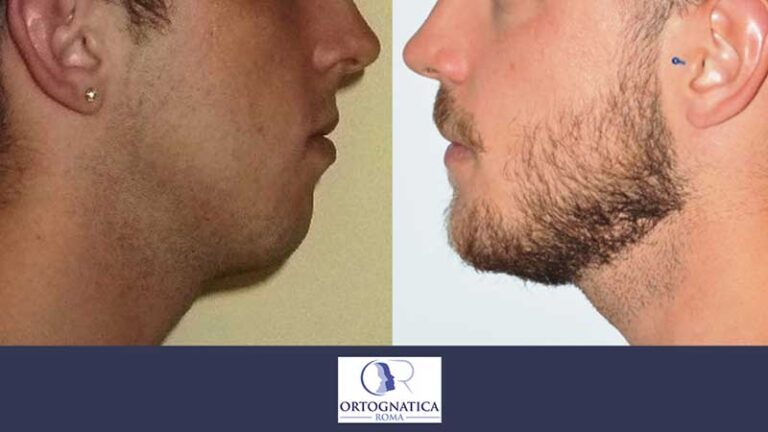 Addio al mento sfuggente: tutte le soluzioni per ridefinire il profilo ...