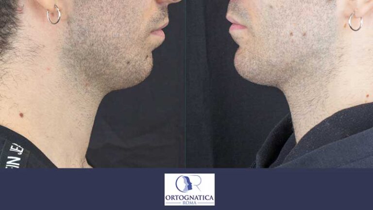 Addio al mento sfuggente: tutte le soluzioni per ridefinire il profilo ...